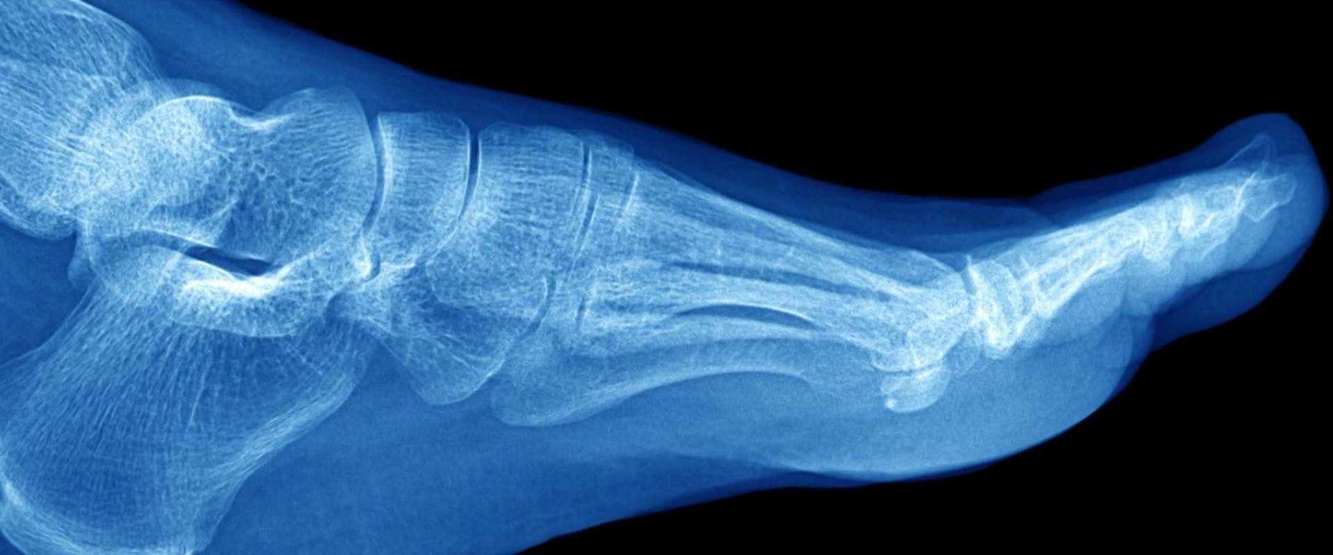Expert Insights: The Impact of Ankle Injuries on Musculoskeletal Health